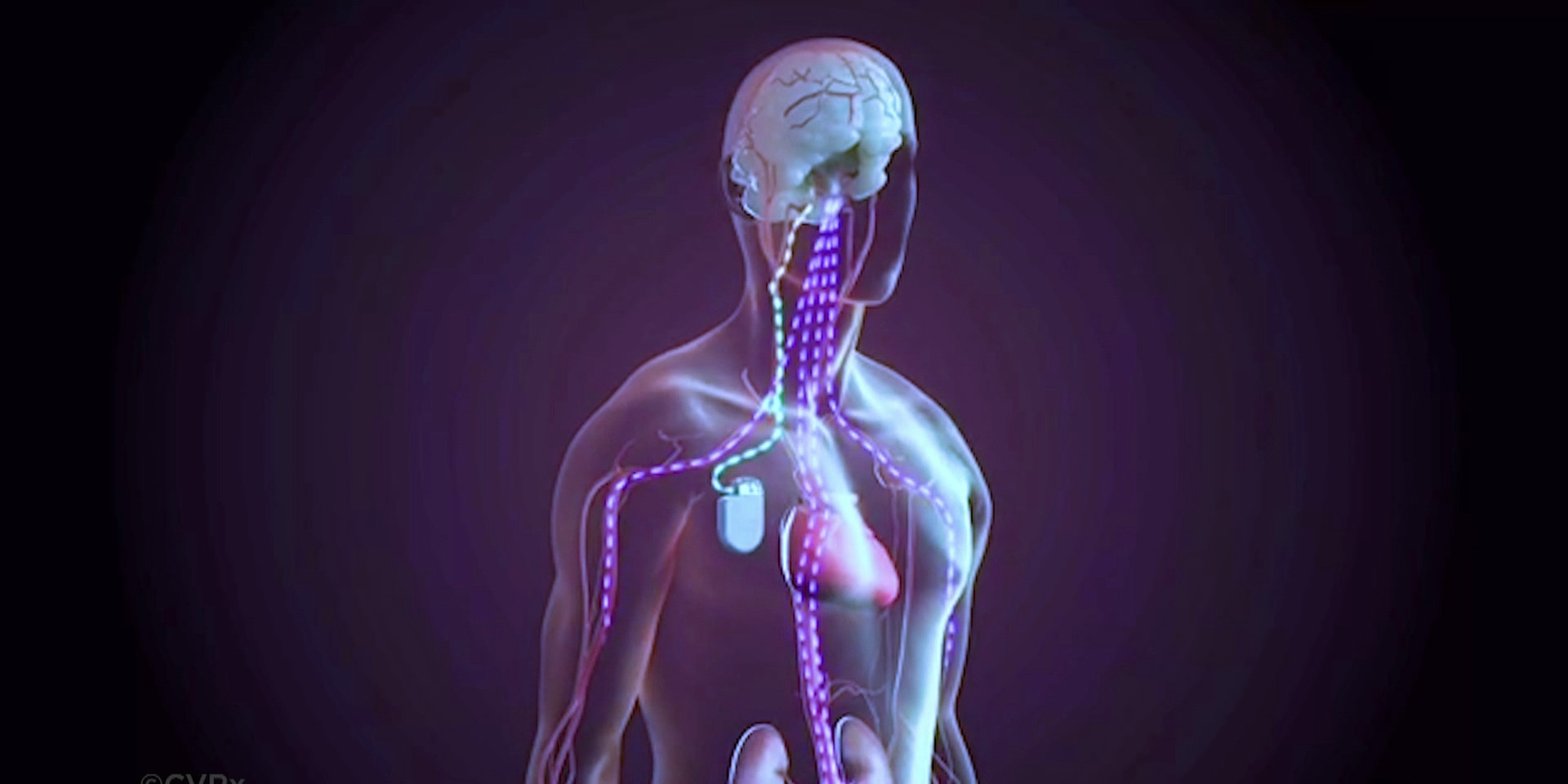 Barostimulator - Implantat gegen Bluthochdruck